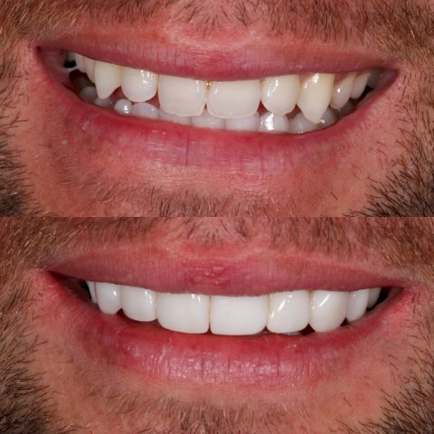 Composite Bonding in Solihull | Dental Bonding