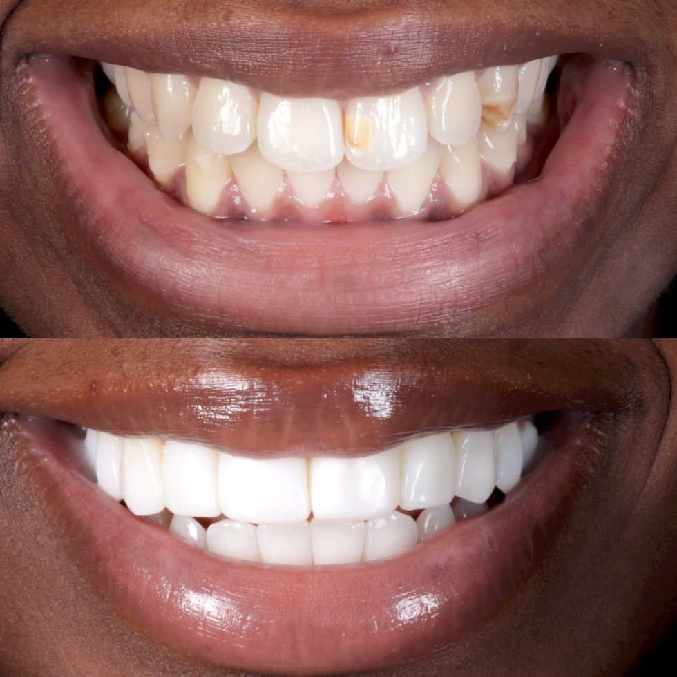 Composite Bonding in Solihull | Dental Bonding